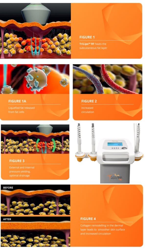 LipoFirm Pro London | Body Toning & Fat Loss