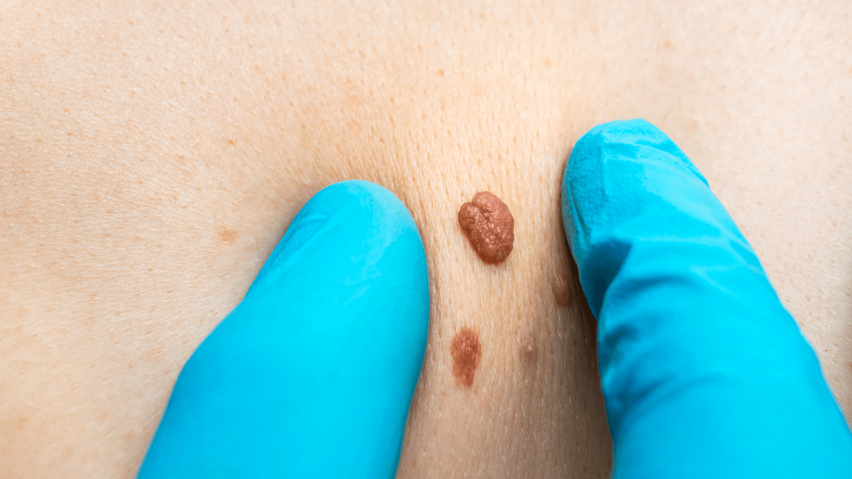 Anal Skin Tags | Everything You Need to Know